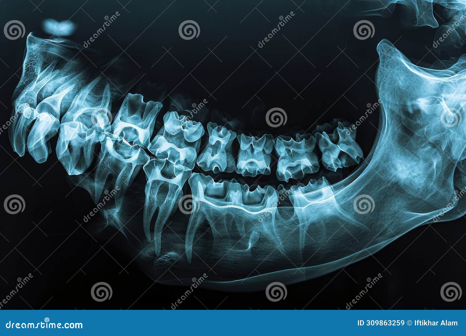 An X-ray Image Showing a Dental Arch with Multiple Teeth Missing, High ...