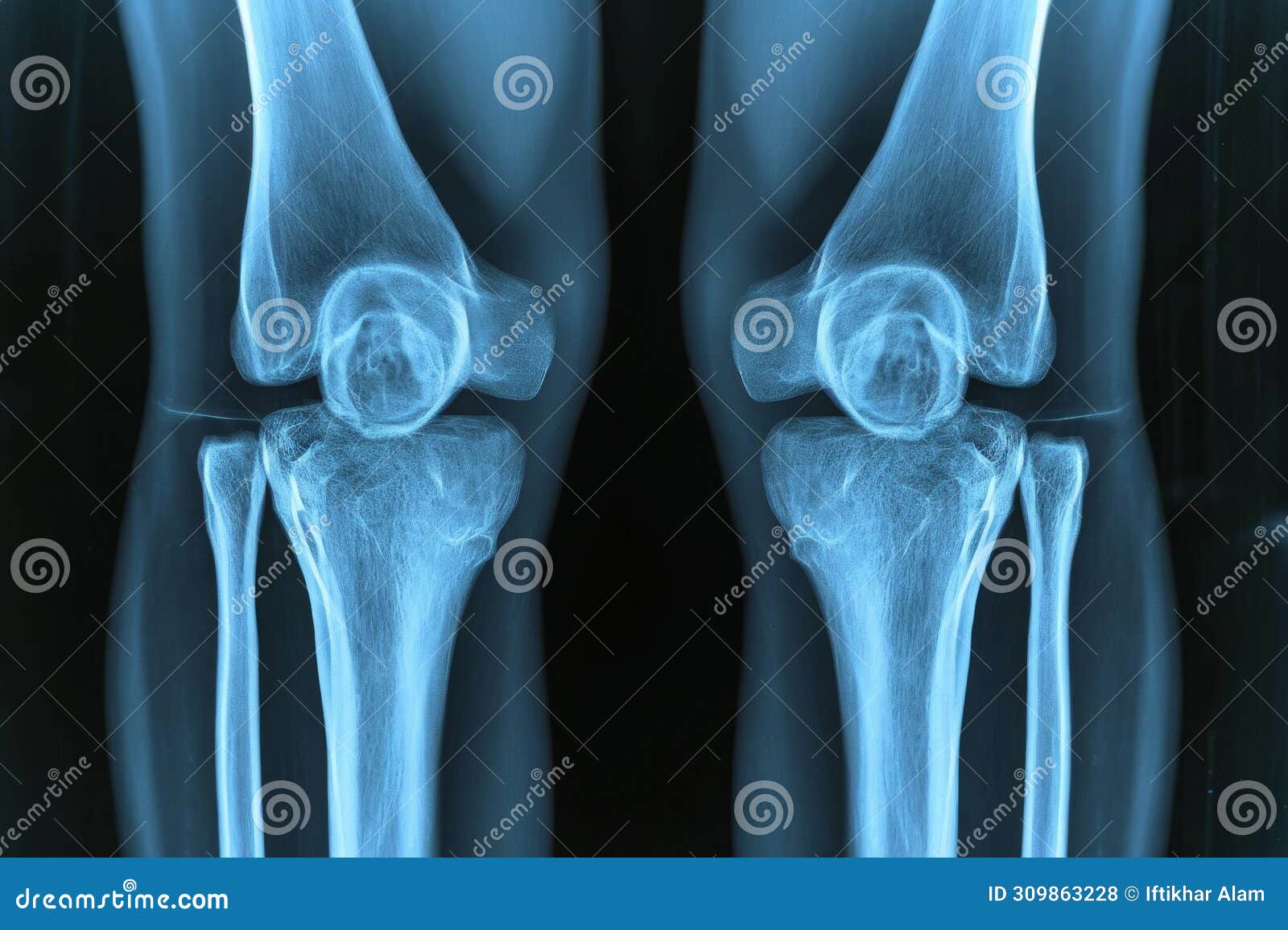 This X-ray Image Shows a Detailed View of a Knee Joint, Providing ...