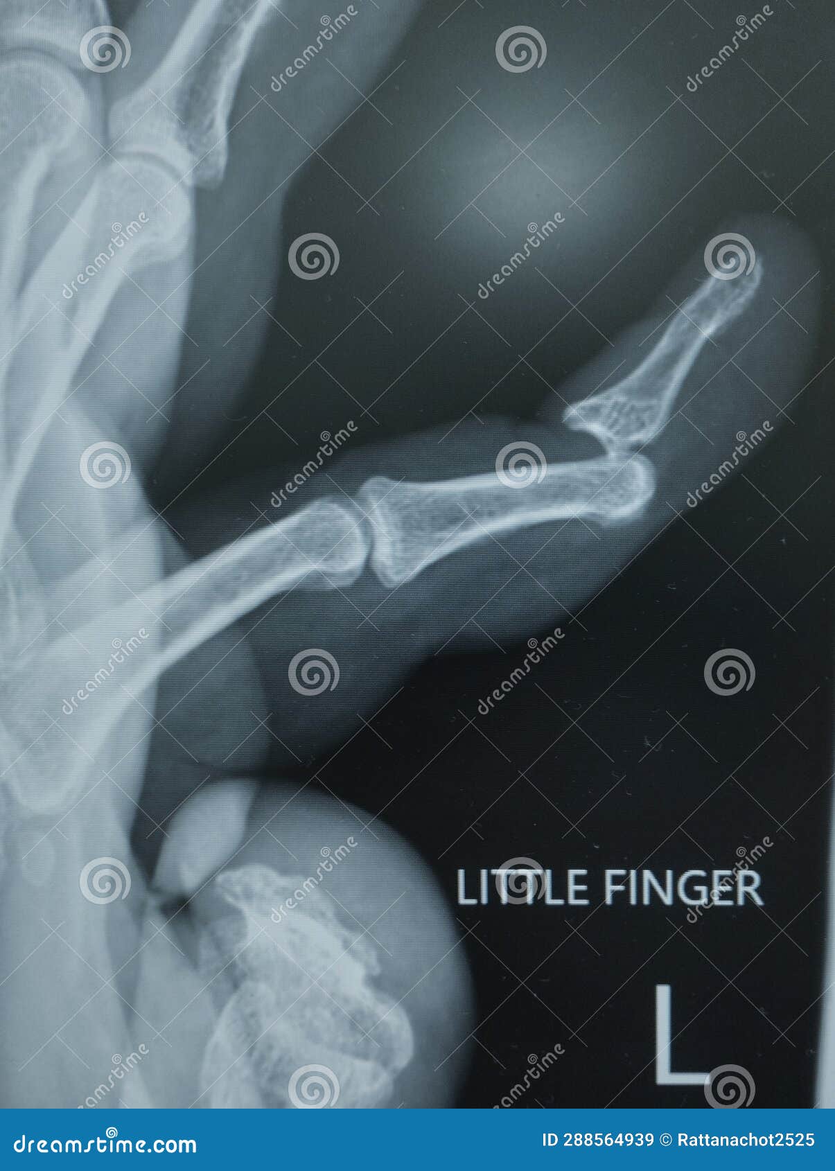 X-ray Image Shows Dislocation Of The Proximal Joint Of Left Little ...