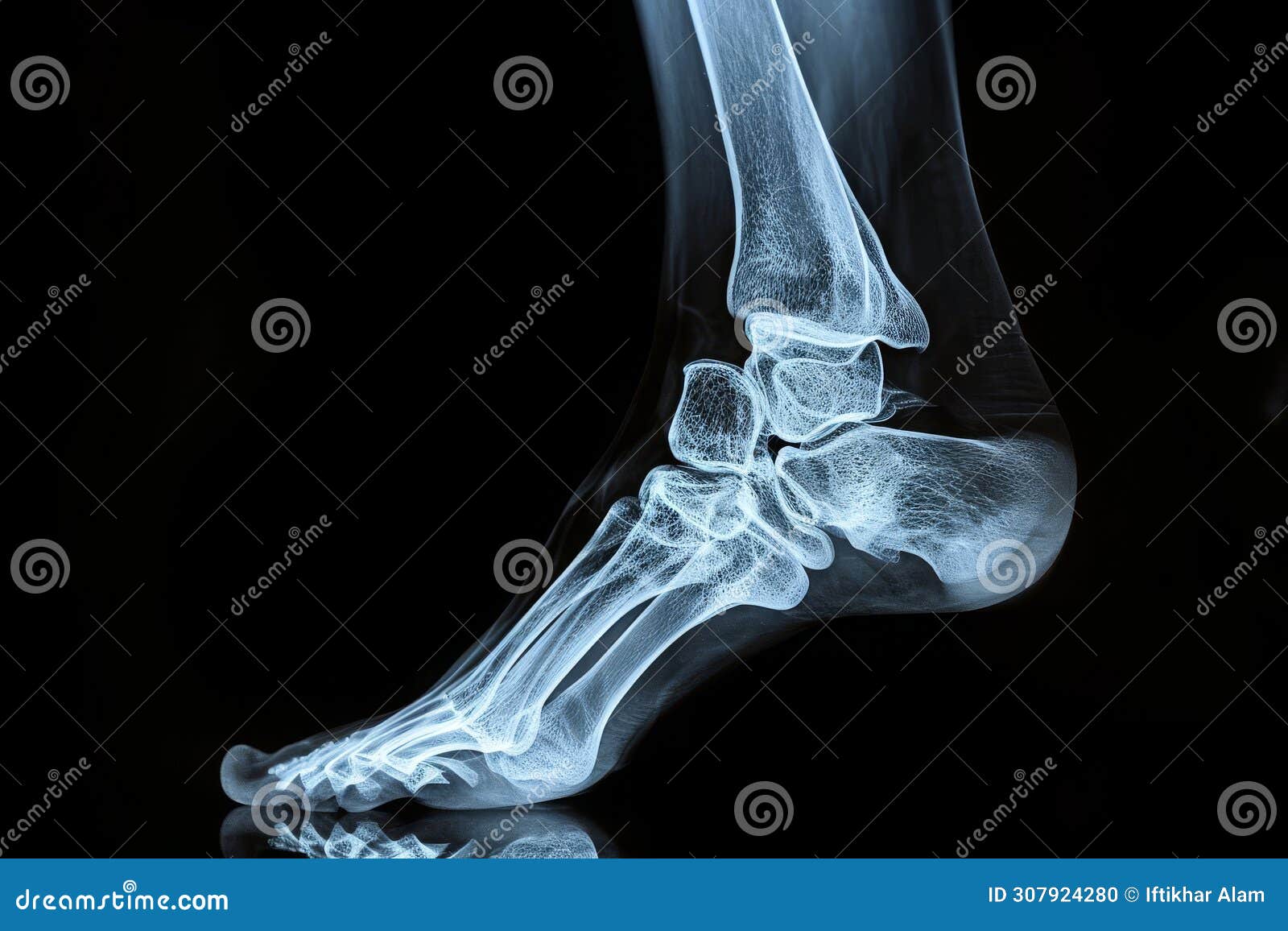 This X-ray Image Shows the Skeletal Structure of a Foot with a Visible ...