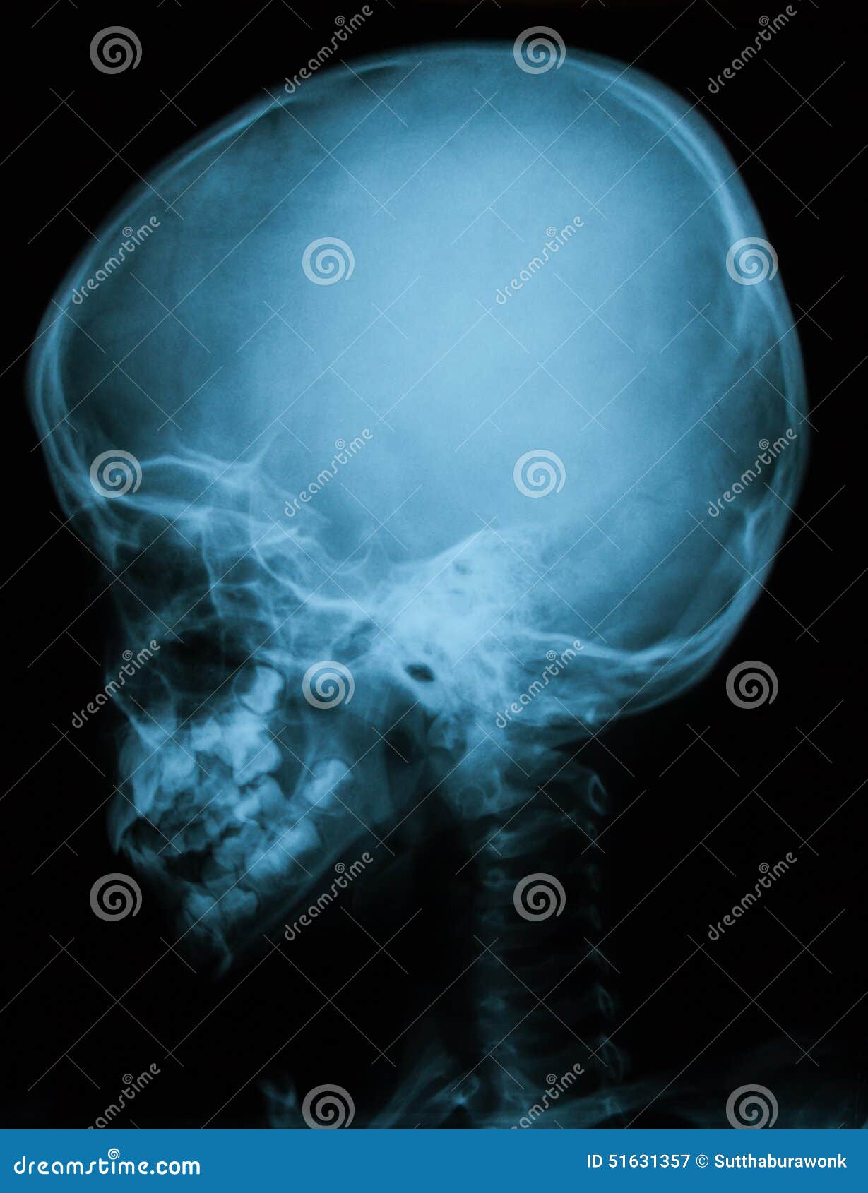 Xray Image Of Skull Lateral View Stock Image Image Of Hasil gambar ...