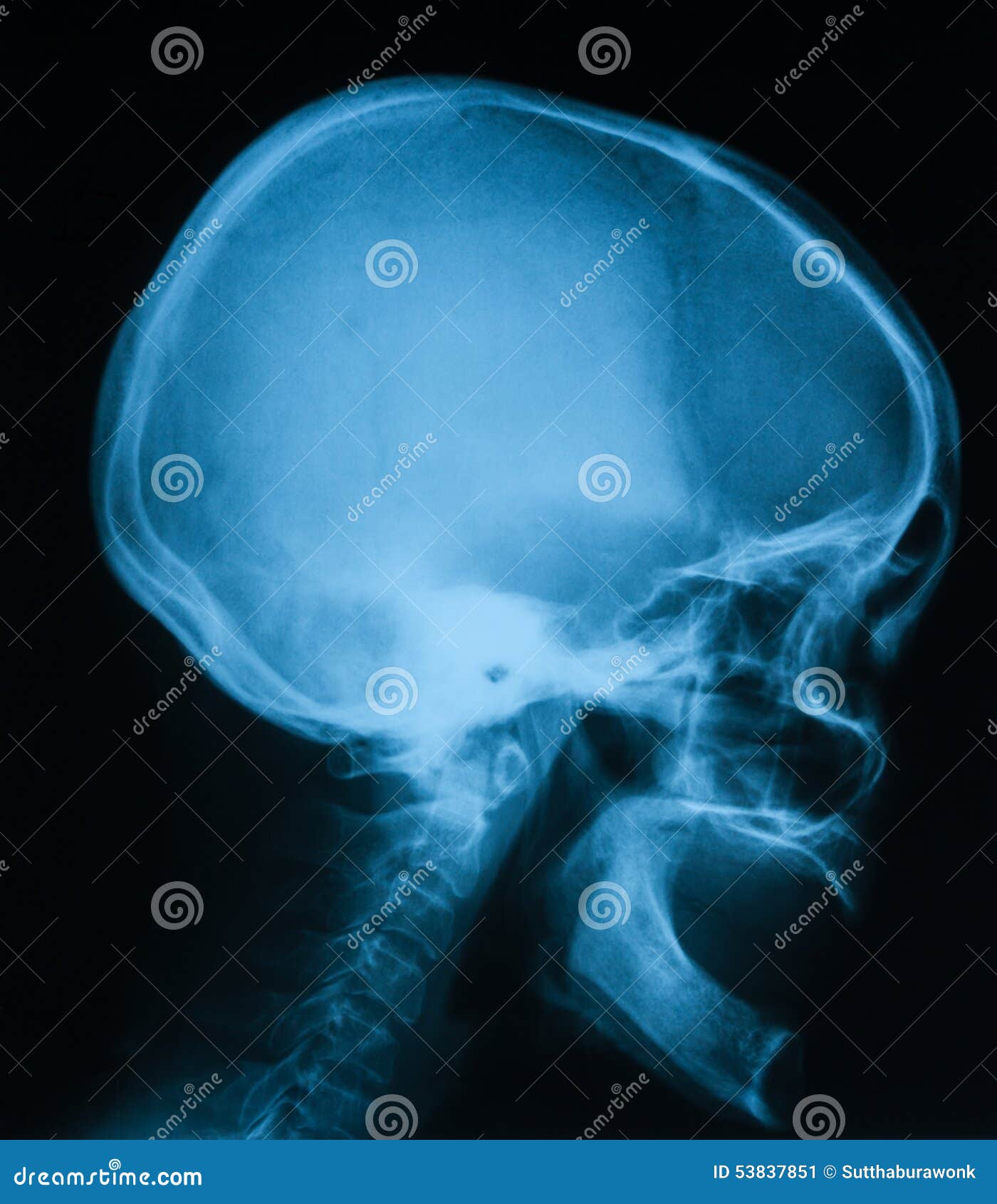 X-ray Image of Skull, Lateral View. Stock Image - Image of face ...
