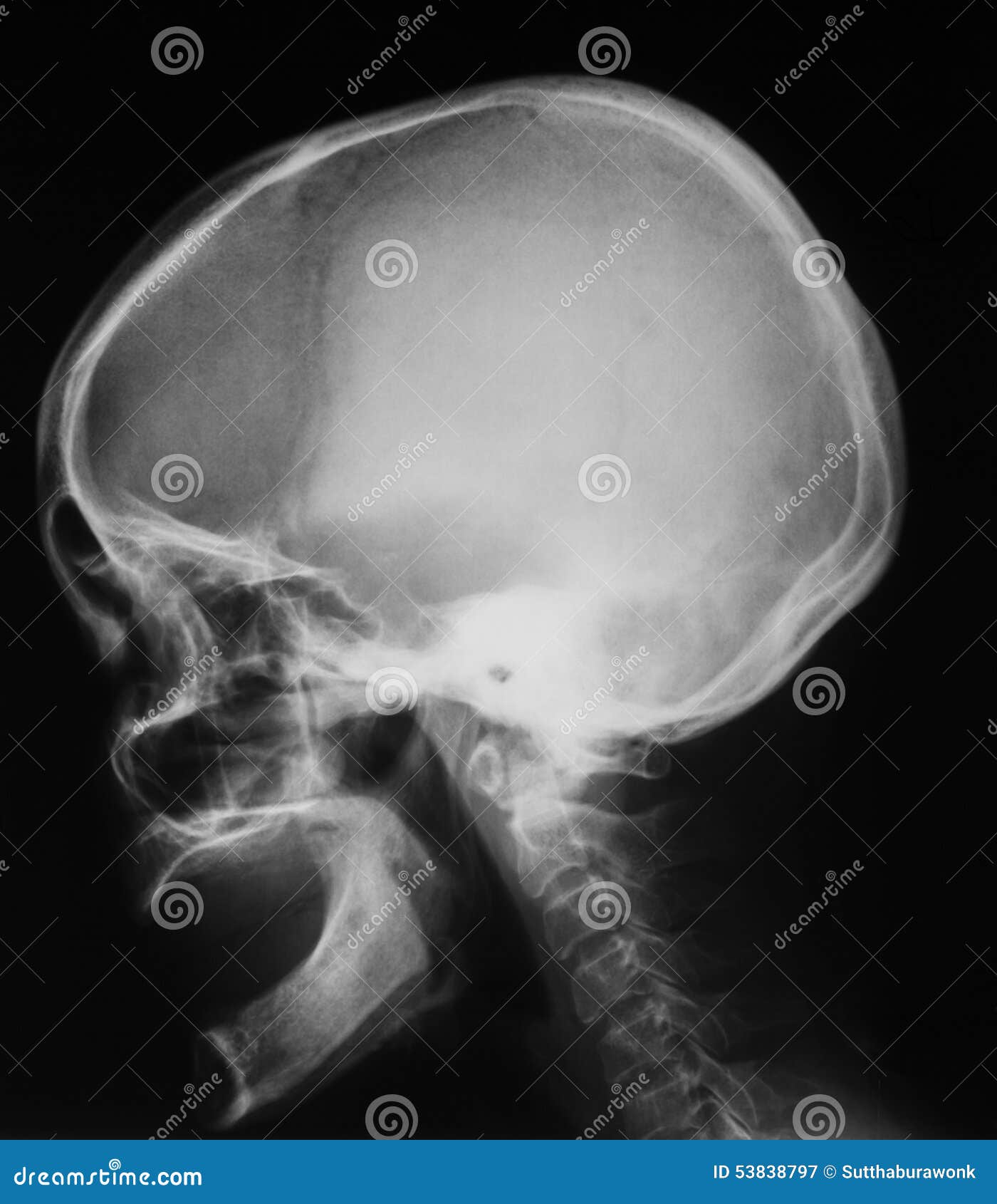Skull X-ray Lateral View Fusion With MRI Brain Sagittal View. Royalty ... Skull X-ray Lateral View Fusion With MRI Brain Sagittal View. Royalty ...