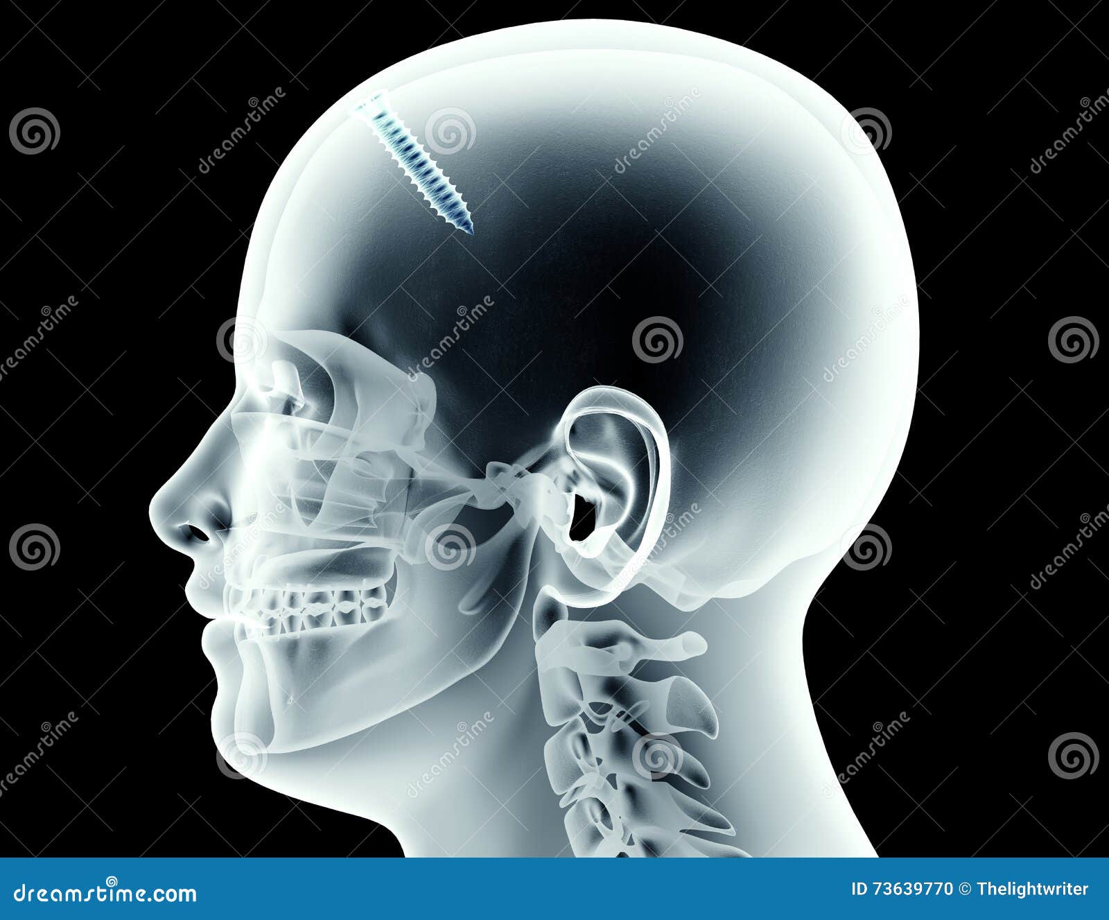 X-ray Image of a Skull with a Stock Illustration - Illustration of xray ...