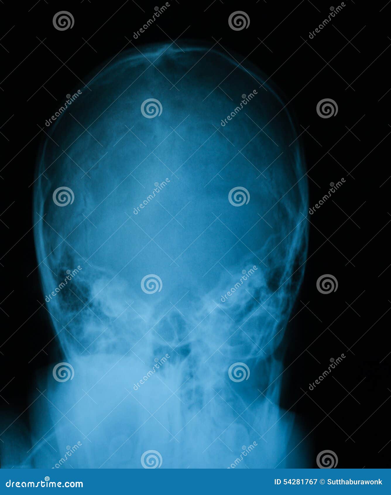 X-ray image of skull. stock image. Image of human, medicine - 54281767