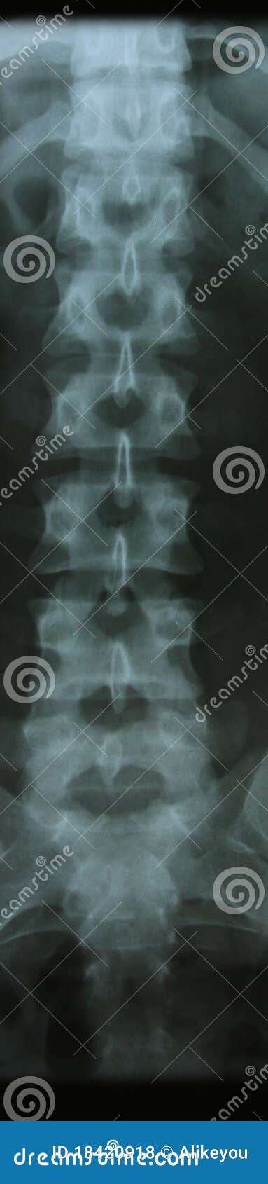 X-ray Image of the Spine Bones Stock Photo - Image of test, report ...