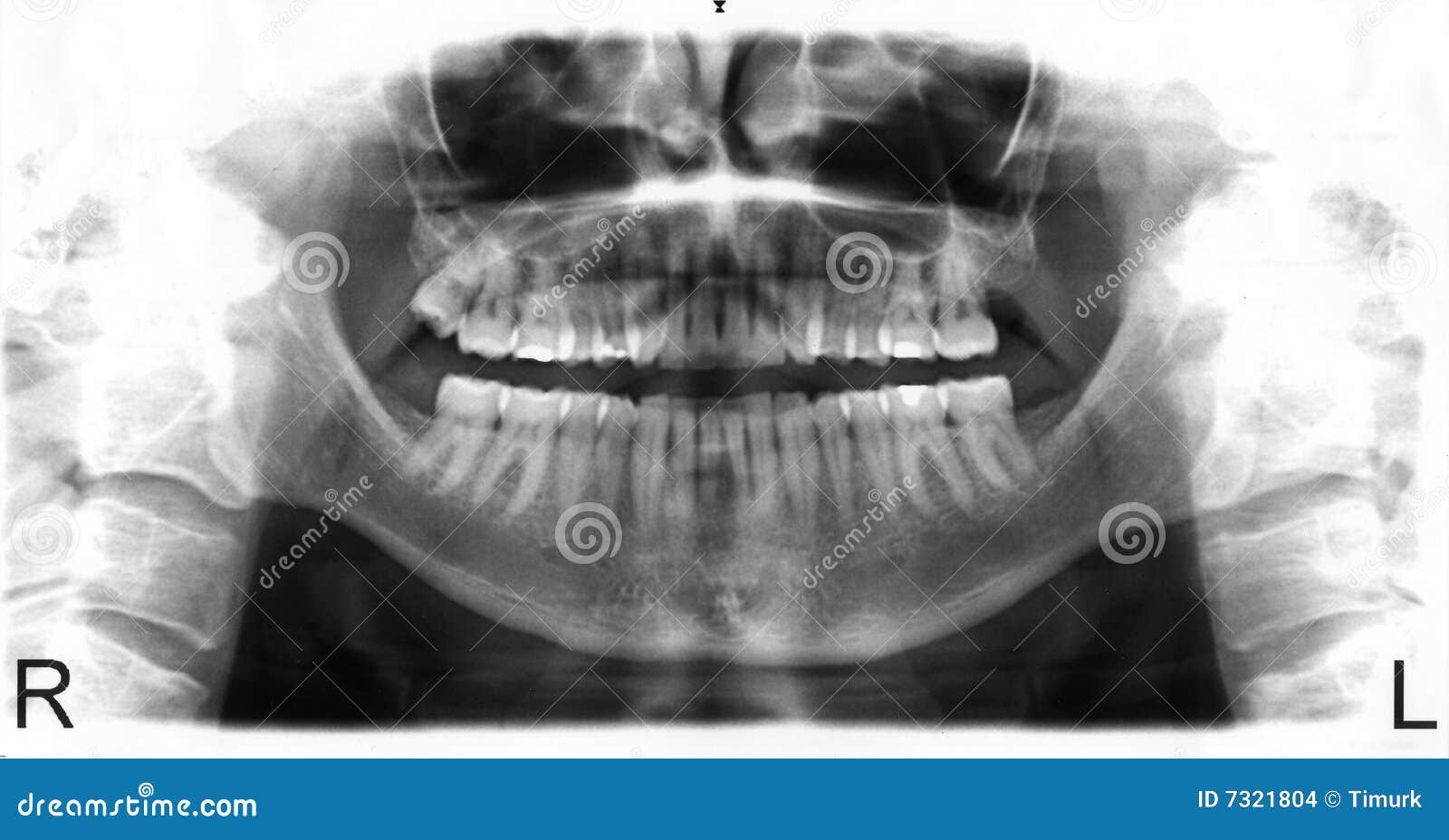 X-ray image of teeth stock photo. Image of medicine, periodontal - 7321804