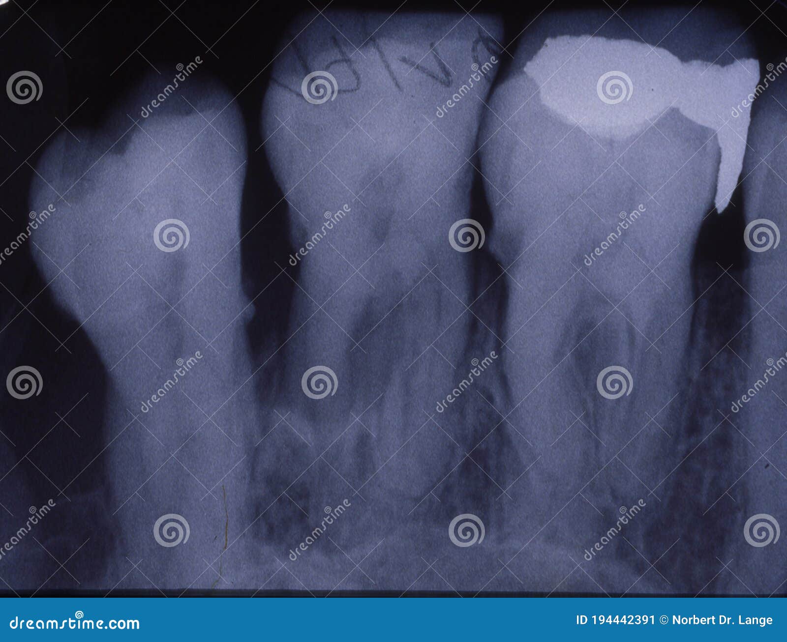 X-ray Image of Teeth with Fillings Stock Image - Image of gums ...