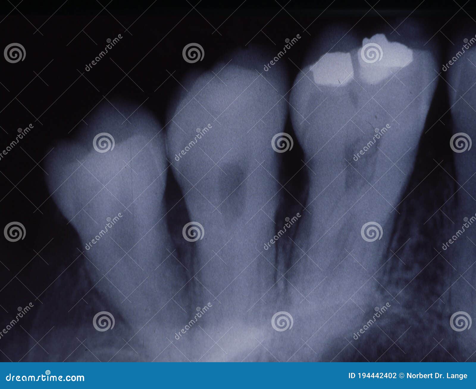 X-ray Image of Teeth with Fillings Stock Photo - Image of dentistry ...