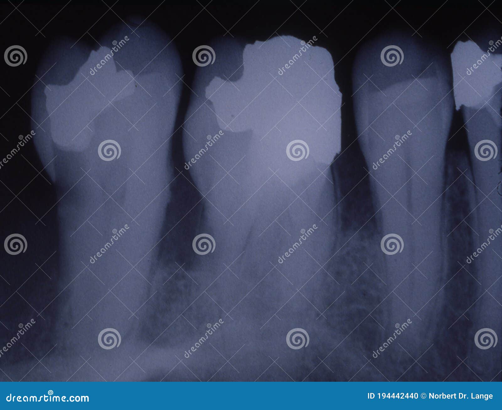 X-ray Image of Teeth with Fillings Stock Photo - Image of enamel ...