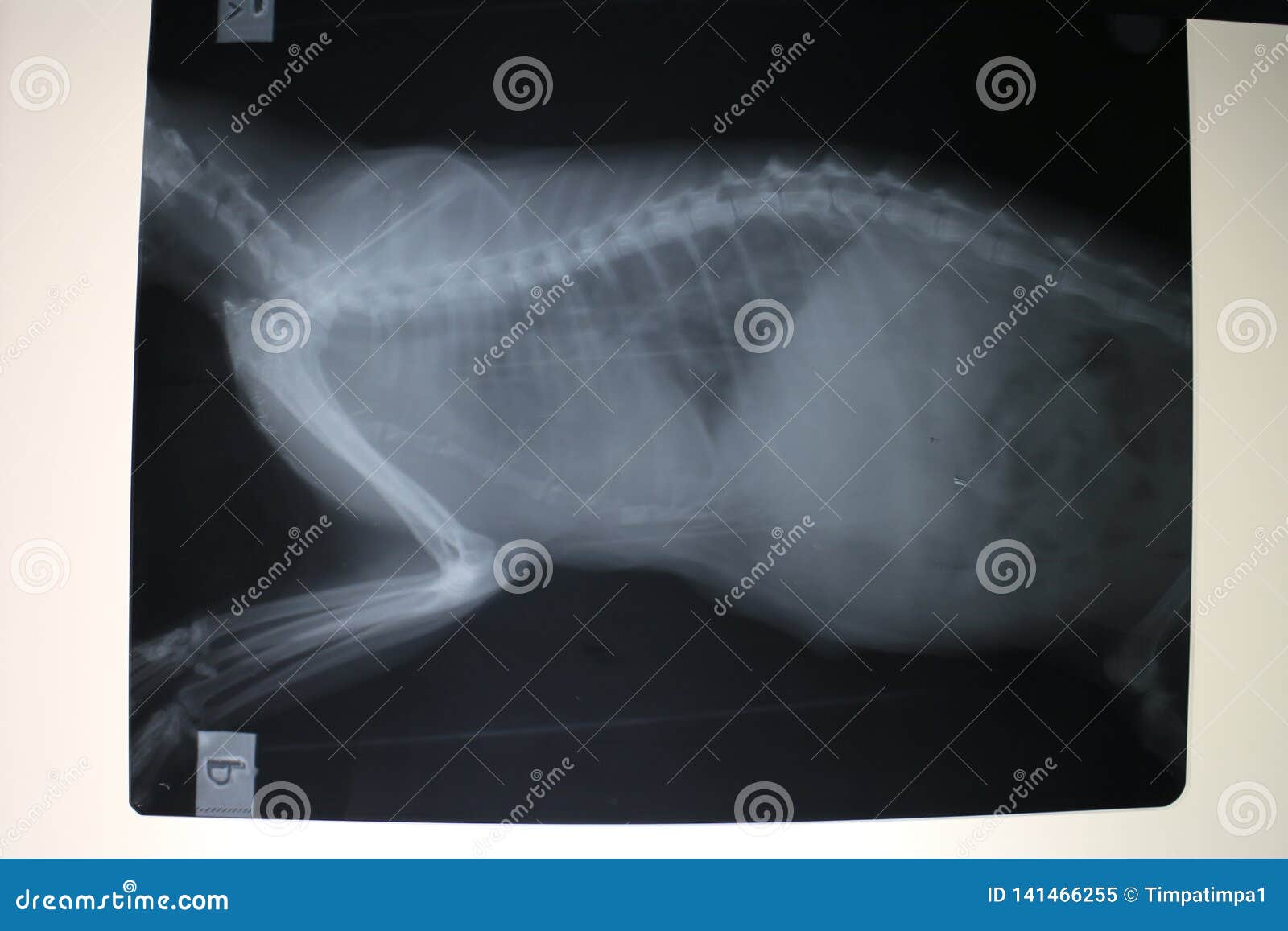 Chest Deformity, Birth Defect. Strong Deformity. Pectus Excavatus ...