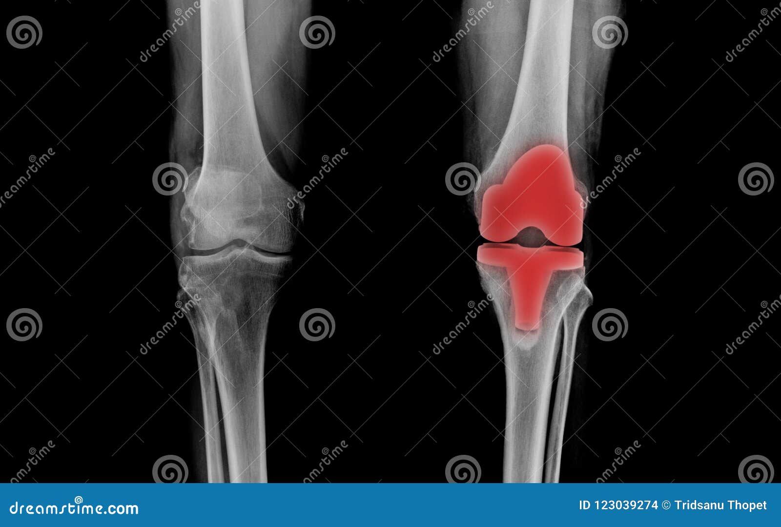 TKA knee joint x-ray stock photo. Image of healthcare - 123039274