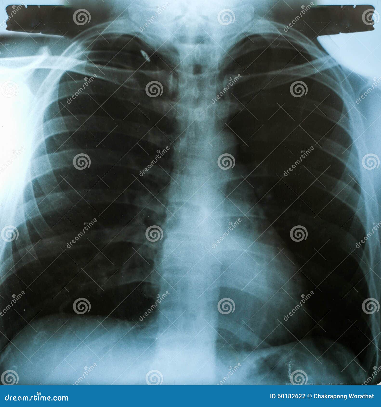 X-Ray Image, View of Chest Men for Medical Diagnosis. Stock Photo ...