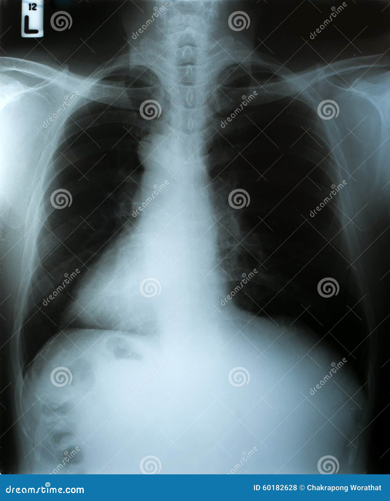 X-Ray Image, View of Chest Men for Medical Diagnosis. Stock Photo ...