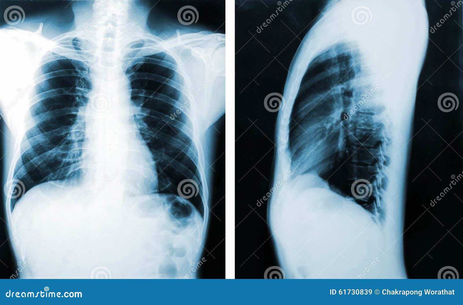 X-Ray Image, View Of Backbone Men For Medical Diagnosis. Stock Photo ...