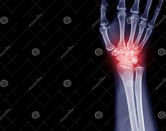X-ray Image of Wrist Joint Front View of Normal Wrist Joint Stock Photo ...
