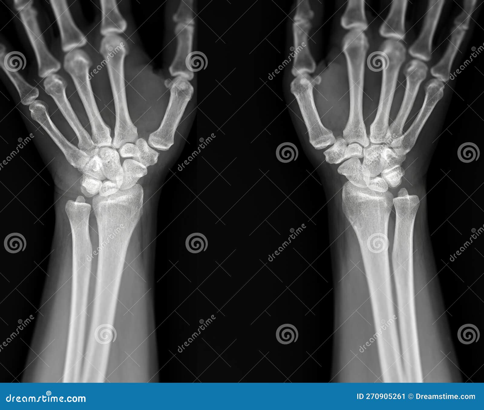 X-ray Image of Wrist Joint Front View of Normal Wrist Joint Stock Image ...