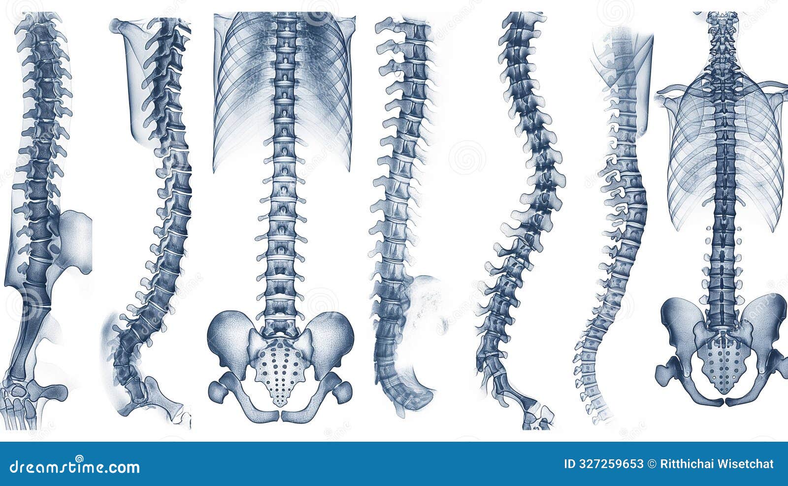 X-ray Images of Human Spines in Various Angles, Highlighting the ...