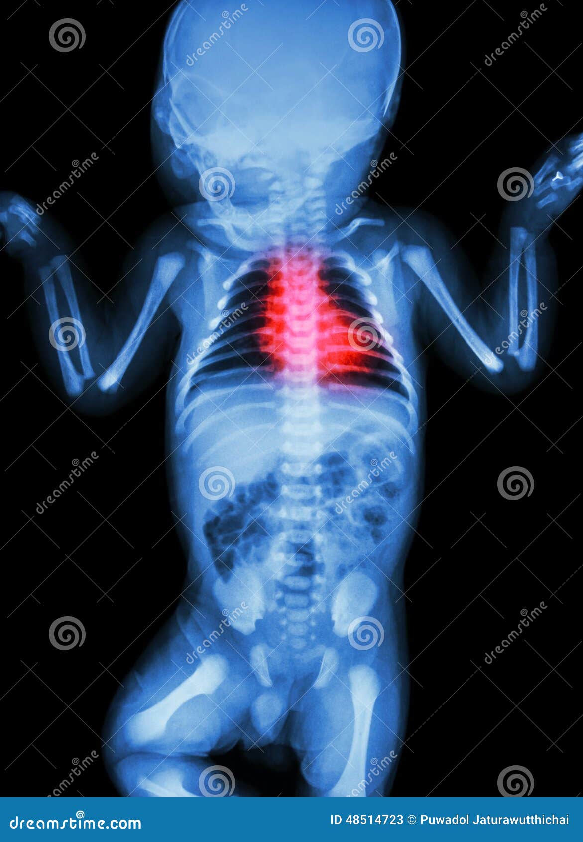 X-ray Infant S Body with Heart Disease Stock Image - Image of disease ...
