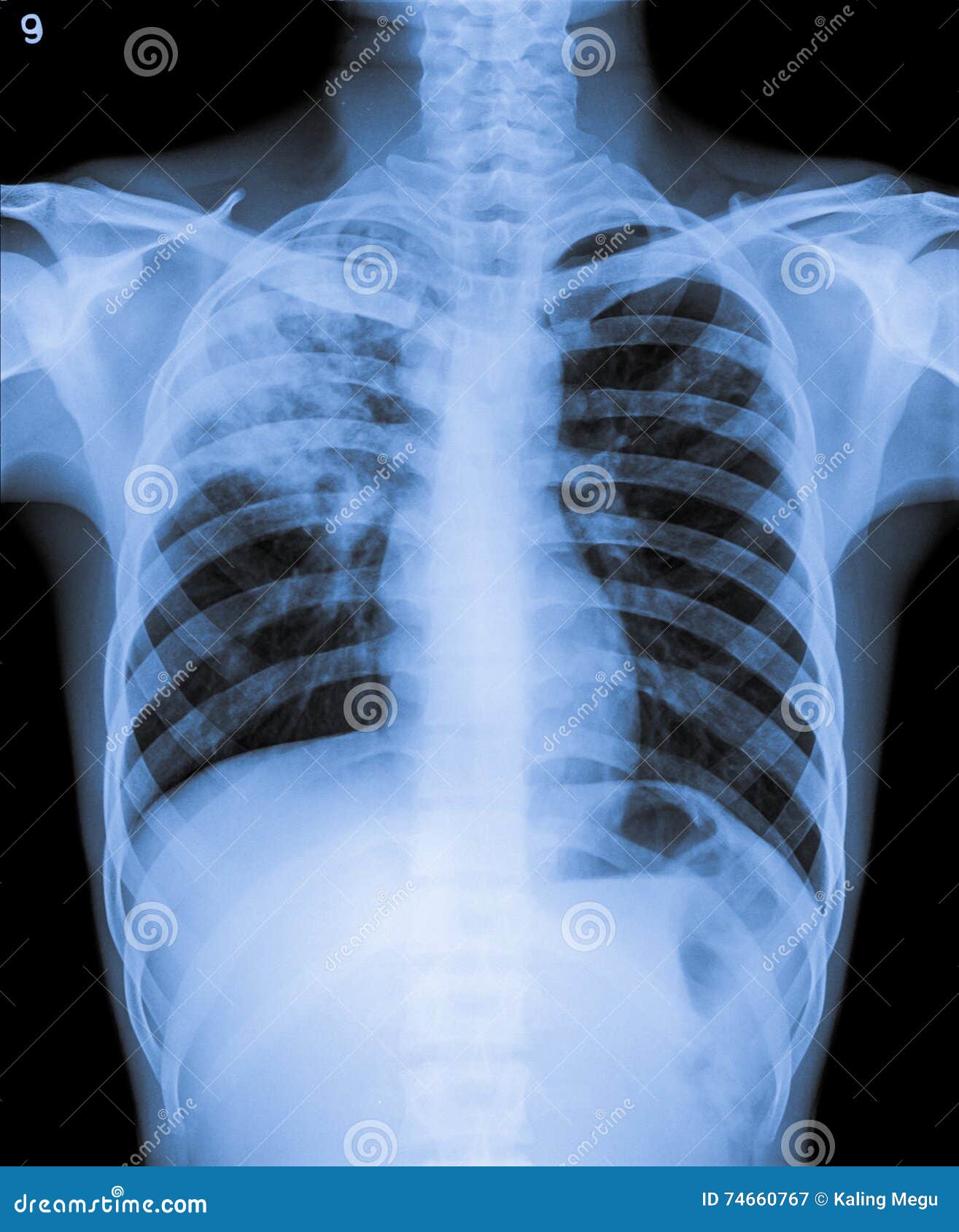 X Ray of infected chest. stock image. Image of diagnosis - 74660767