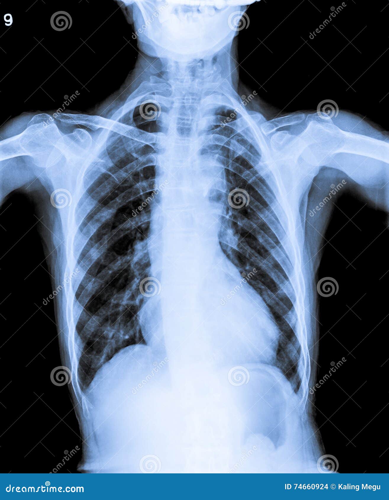 X Ray of infected chest. stock photo. Image of skeleton - 74660924