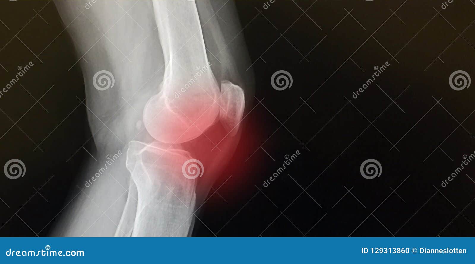 X-Ray of an Inflamed Knee Joint in Black, White and Red Stock Photo ...
