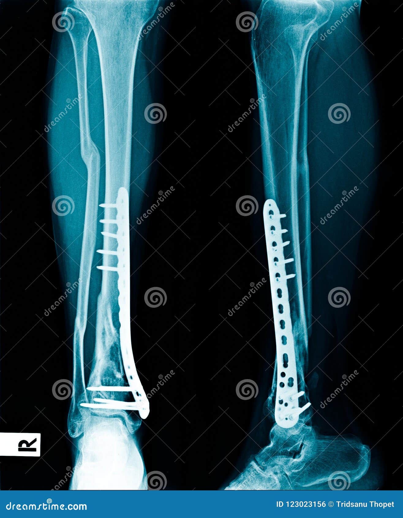 Distal Tibia