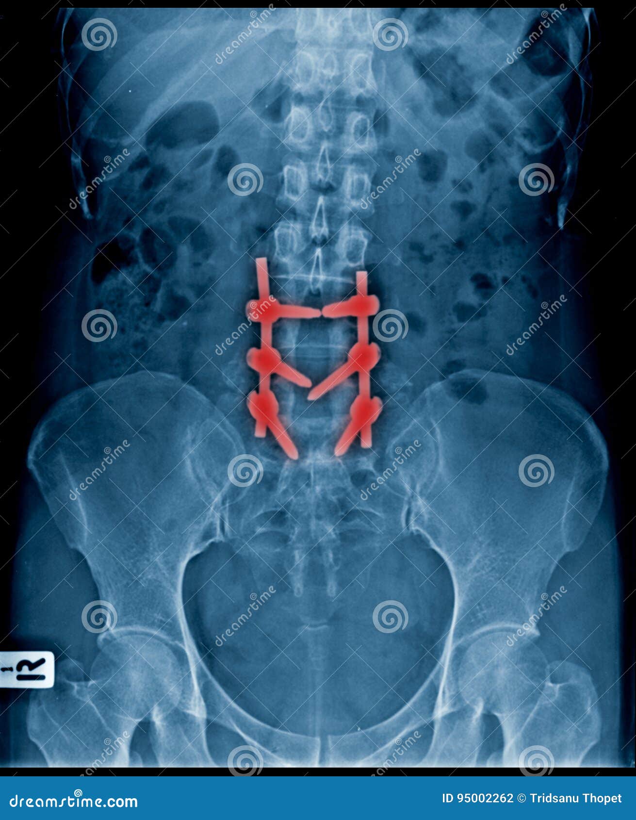 X-ray Internal Fixator Stock Photography | CartoonDealer.com #95002262 X-ray Internal Fixator Stock Photography | CartoonDealer.com #95002262