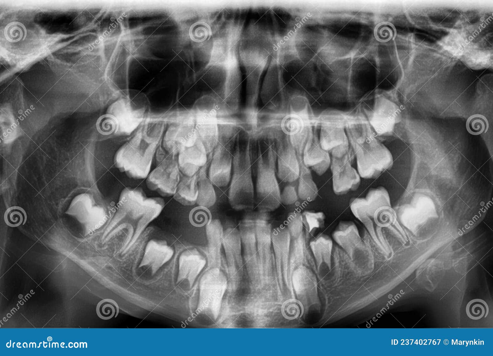 X-ray of the Jaw of an 8-year-old Child Stock Image - Image of scan ...