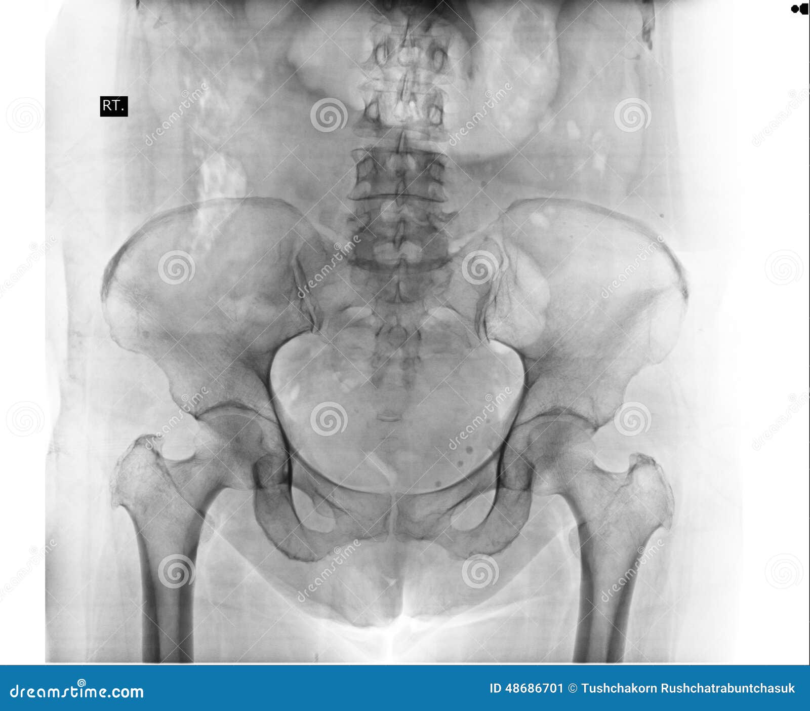 X-ray of Kidney-ureter-bladd Er (KUB) System. Stock Image - Image of ...