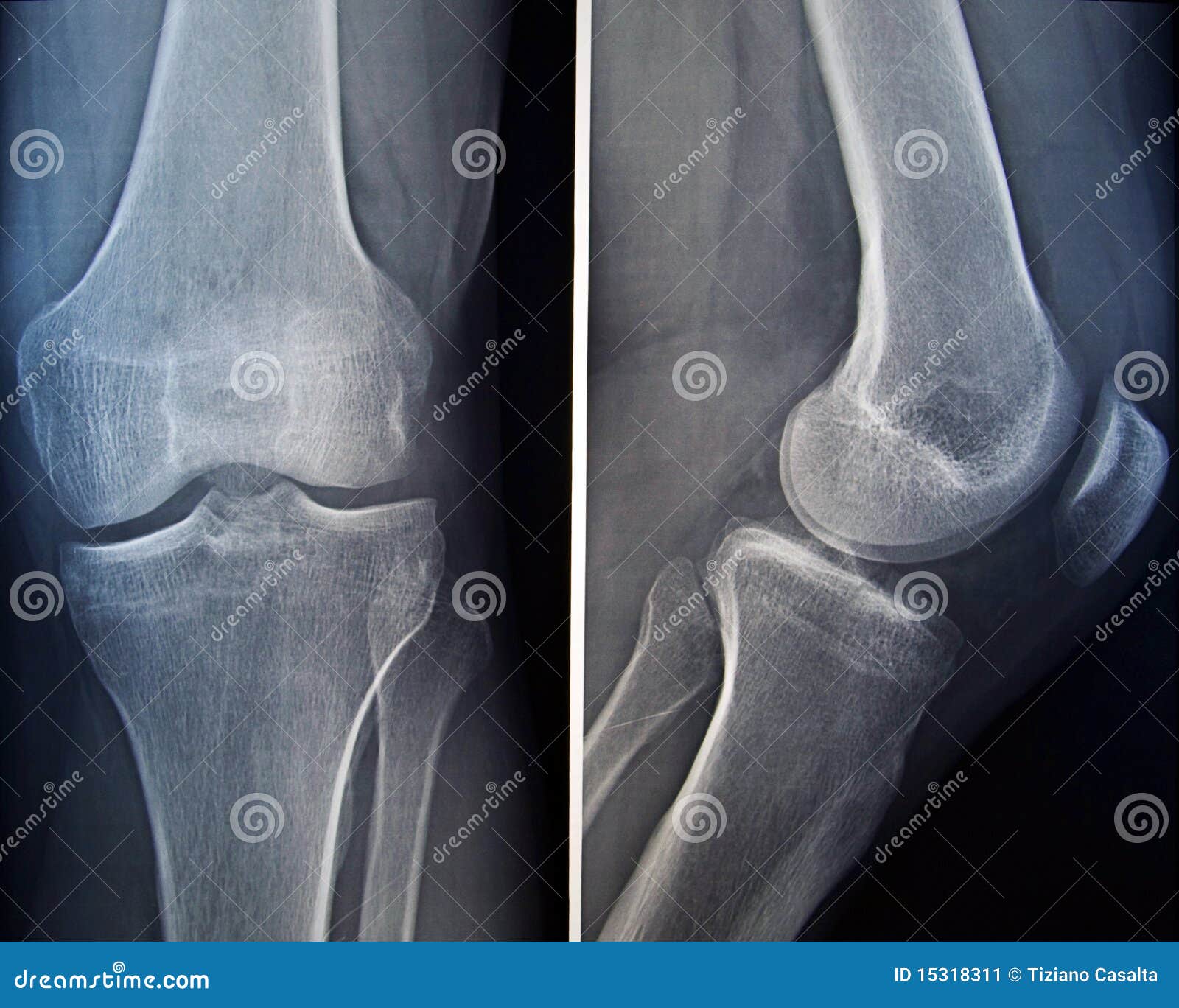 X-ray of a knee stock image. Image of metal, emergency - 15318311