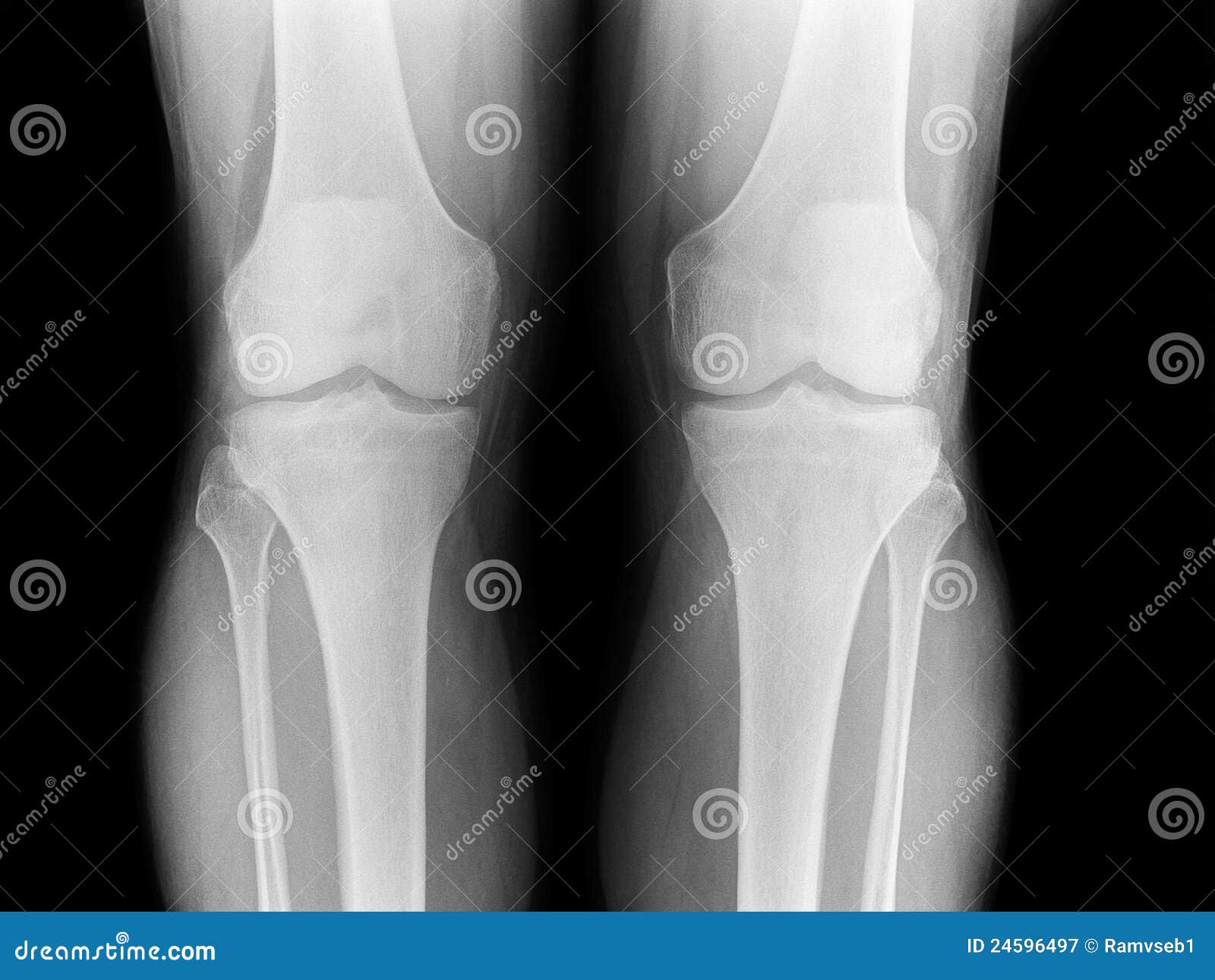 X-ray of the knee stock image. Image of clinical, examination - 24596497