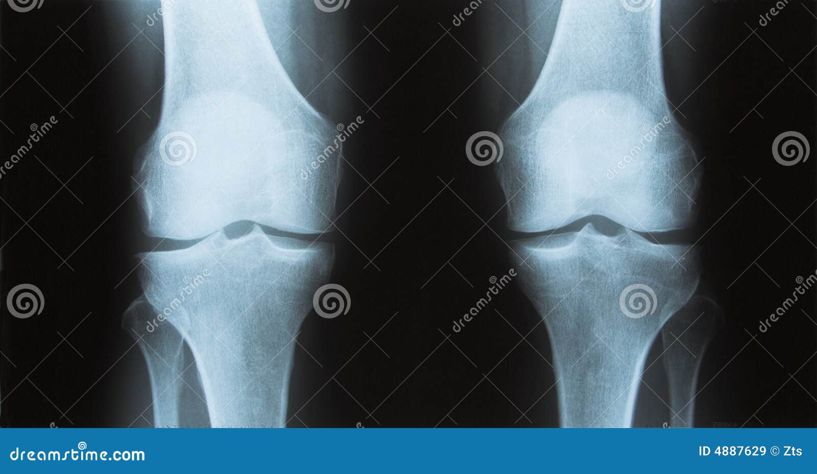 X-ray of the knee stock image. Image of medical, kneecap - 4887629
