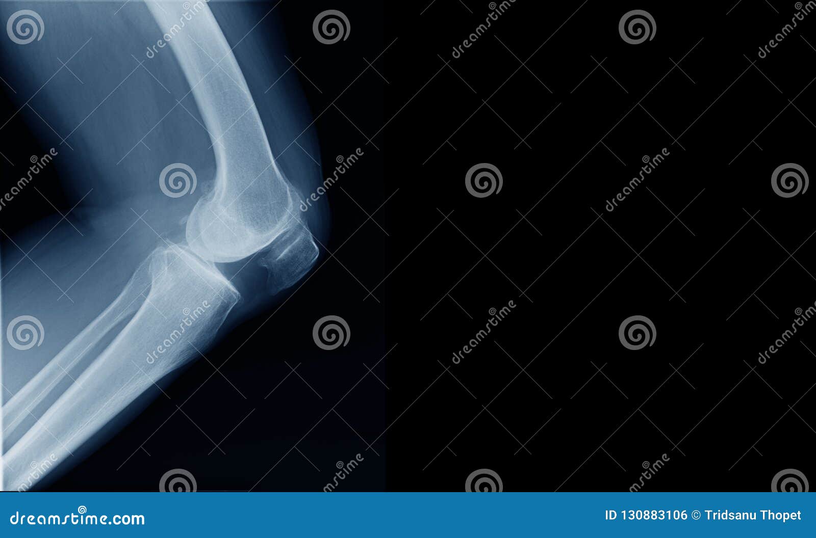 Hight Quality of Knee in Flexion Position Stock Photo - Image of banner ...