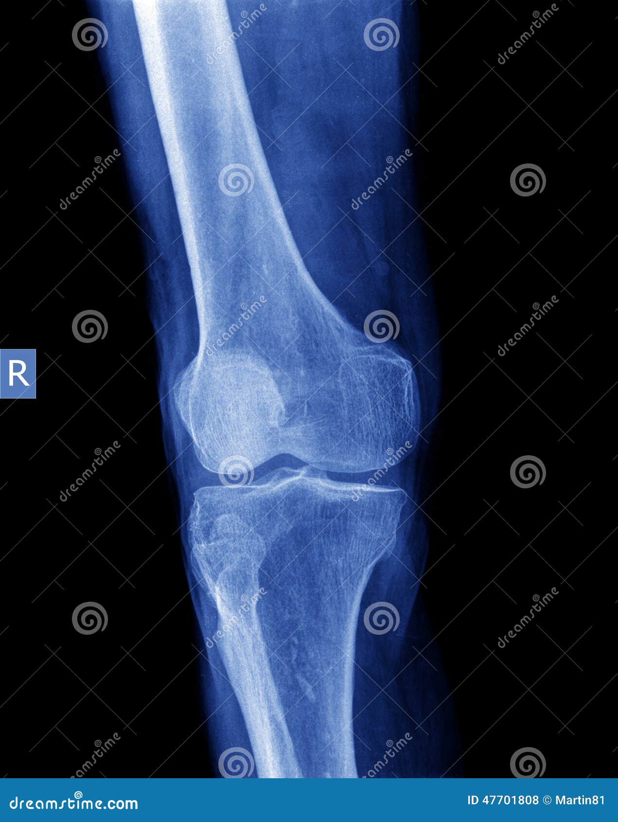 X-ray of knee stock photo. Image of radiologist, nurse - 47701808