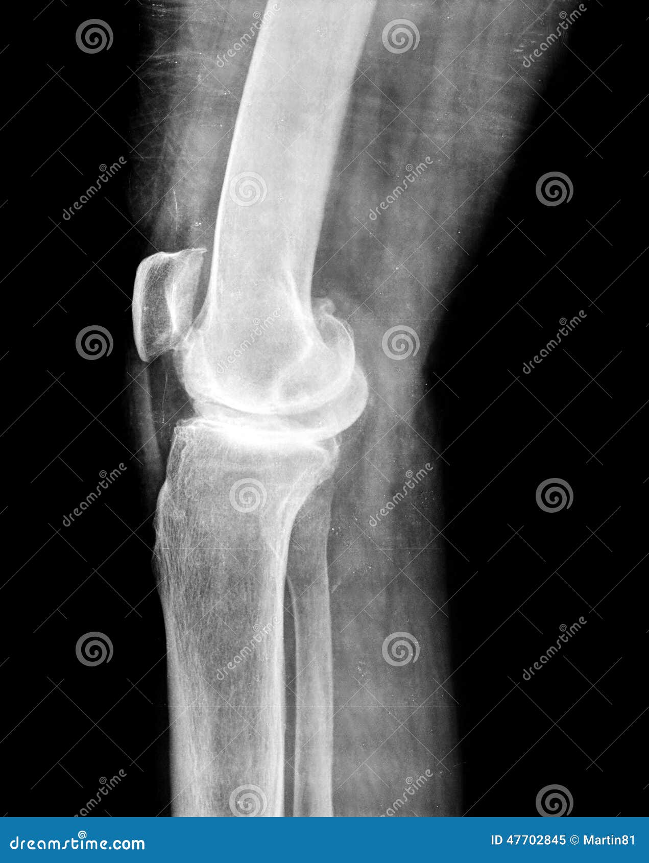 X-ray of knee stock image. Image of human, process, surgery - 47702845