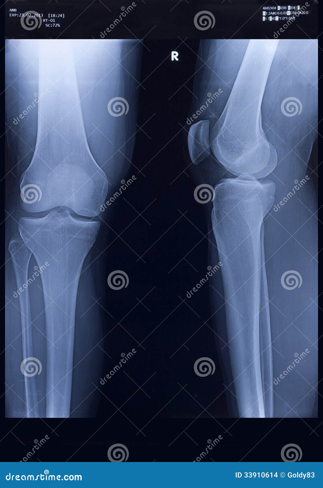 X-Ray, Knee stock photo. Image of left, cartilage, side - 33910614