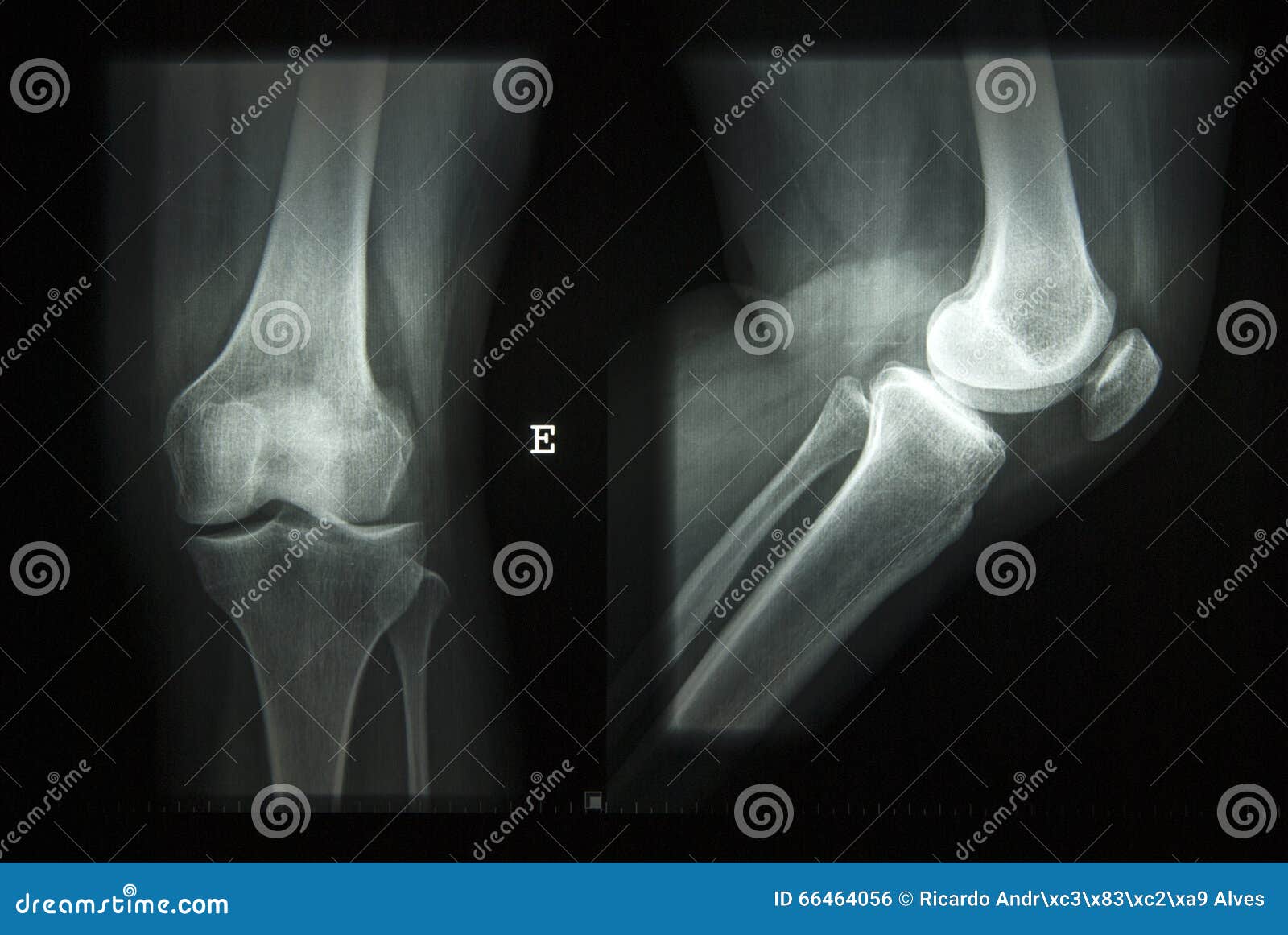 Normal Knee Left Image And Osteoarthritis Knee Right Image Lateral View ...