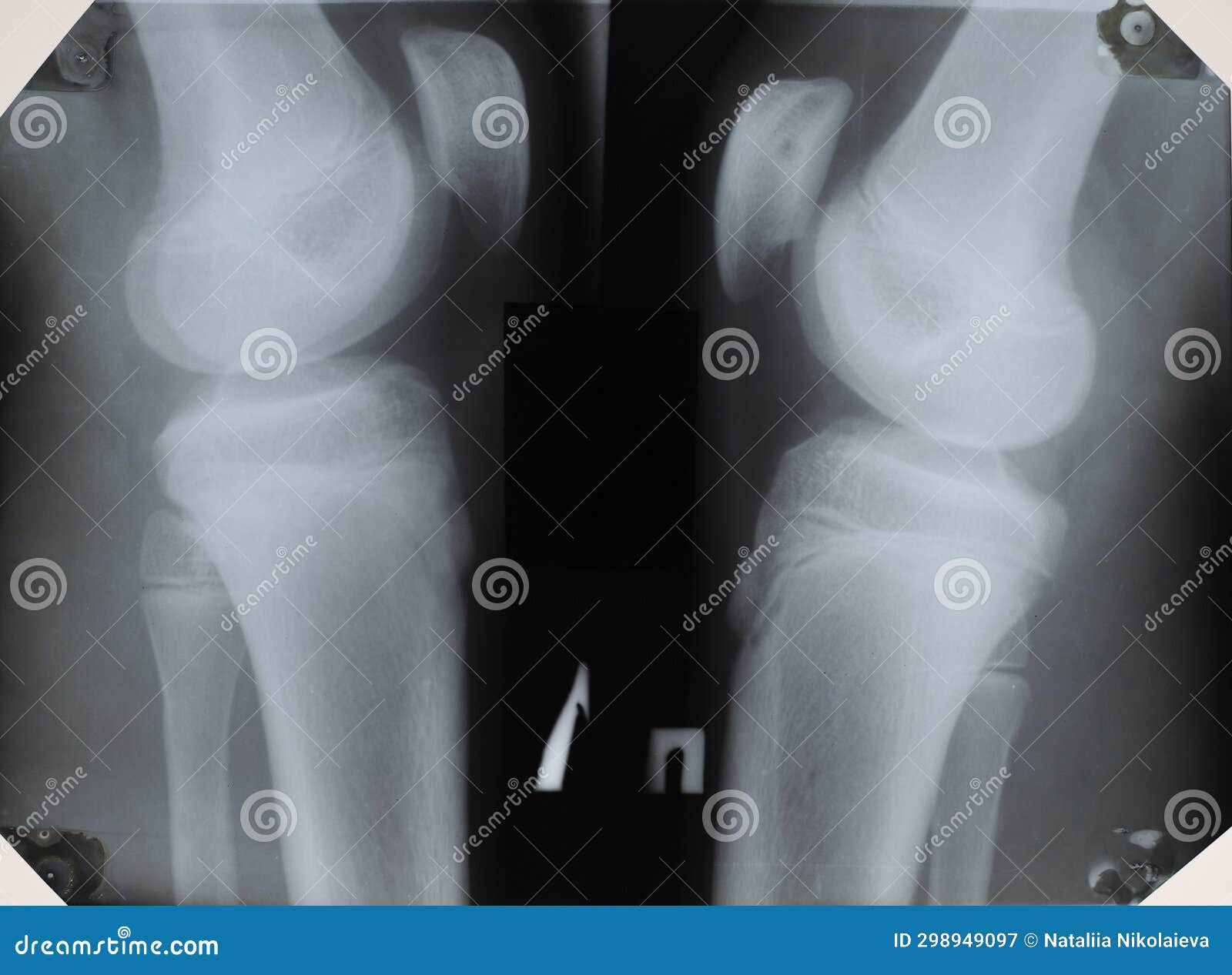 X-ray of the Knee Joint. for Medical Use. Clinic Stock Image - Image of ...