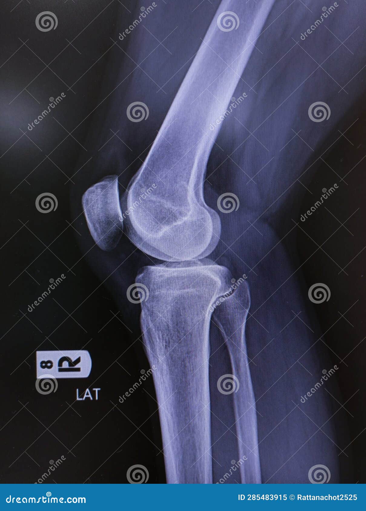 X-ray of Knee Joint Side View. Normal Joint and Space, Medical Image ...