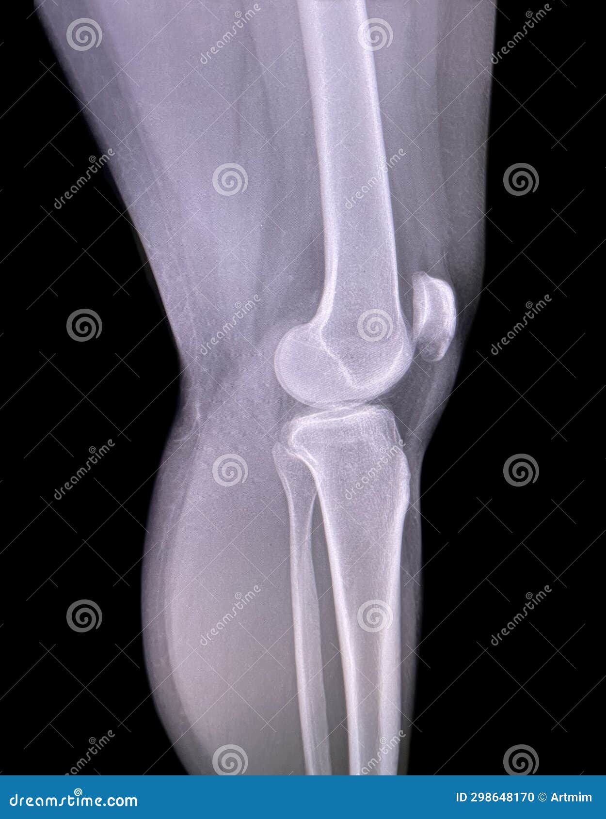 X-ray of Knee Joint, Side View Stock Photo - Image of skeleton, bone ...