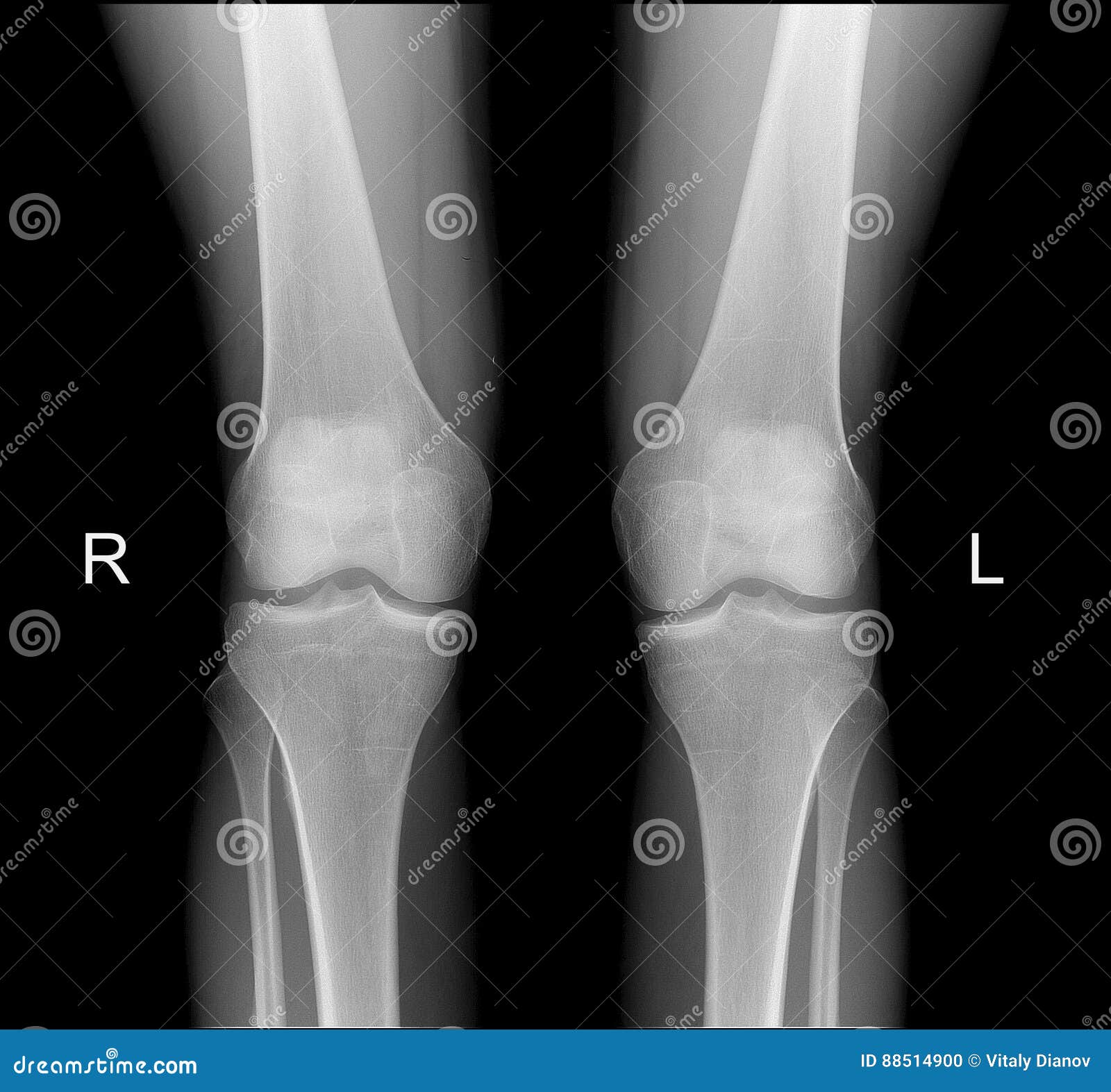 X-ray of Knee Joints in Frontal Projection Stock Photo - Image of ...