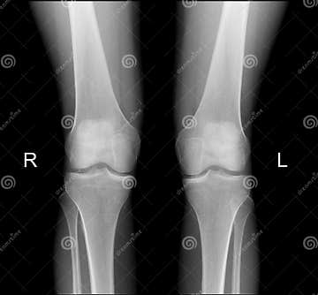 X-ray of Knee Joints in Frontal Projection Stock Photo - Image of ...
