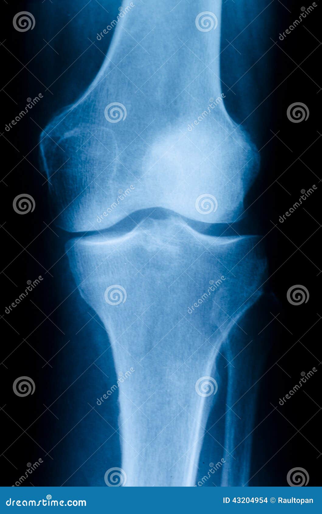 X-ray of the knee stock photo. Image of patellar, lateral - 43204954