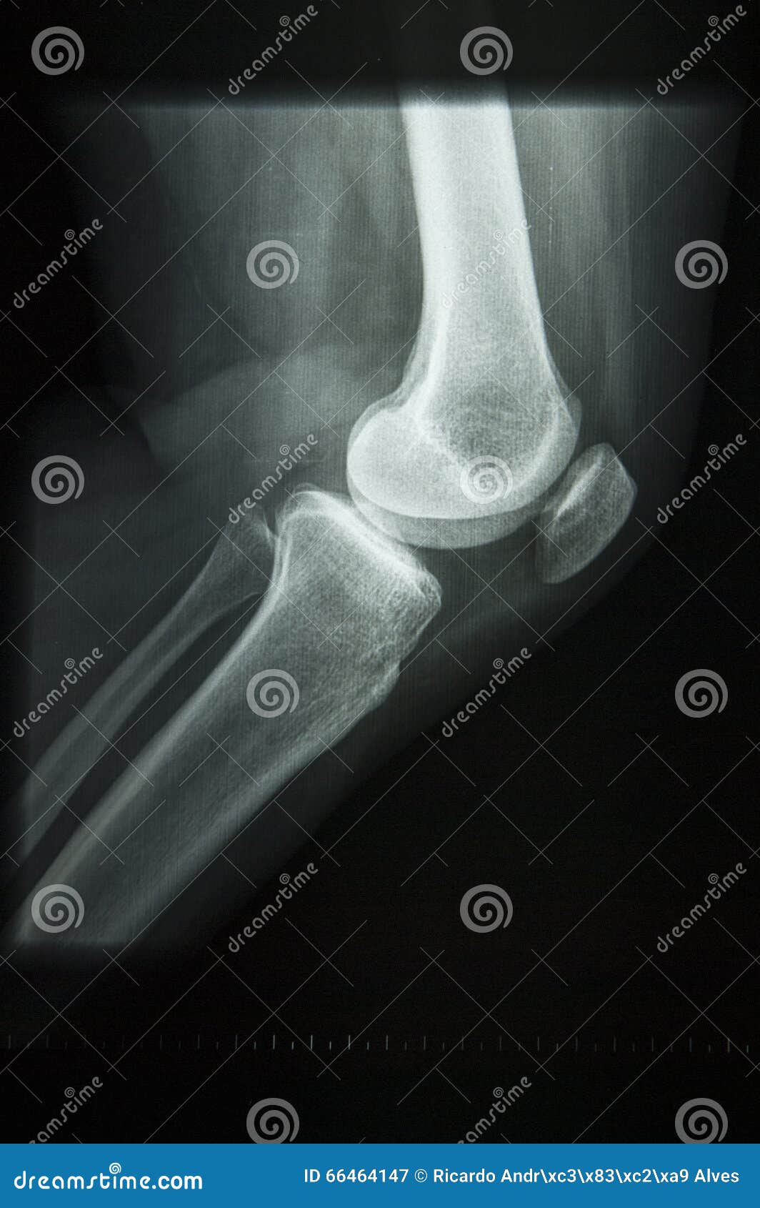 X-Ray of a knee stock image. Image of health, healthcare - 66464147