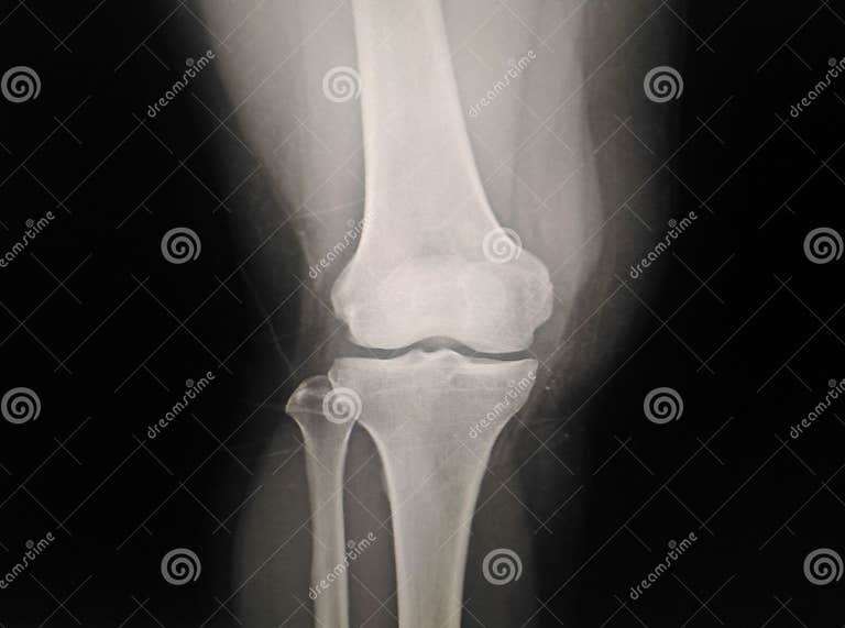 X-ray Knee Ap Normal Radiography of the Knee Joint, Medical Diagnostics ...