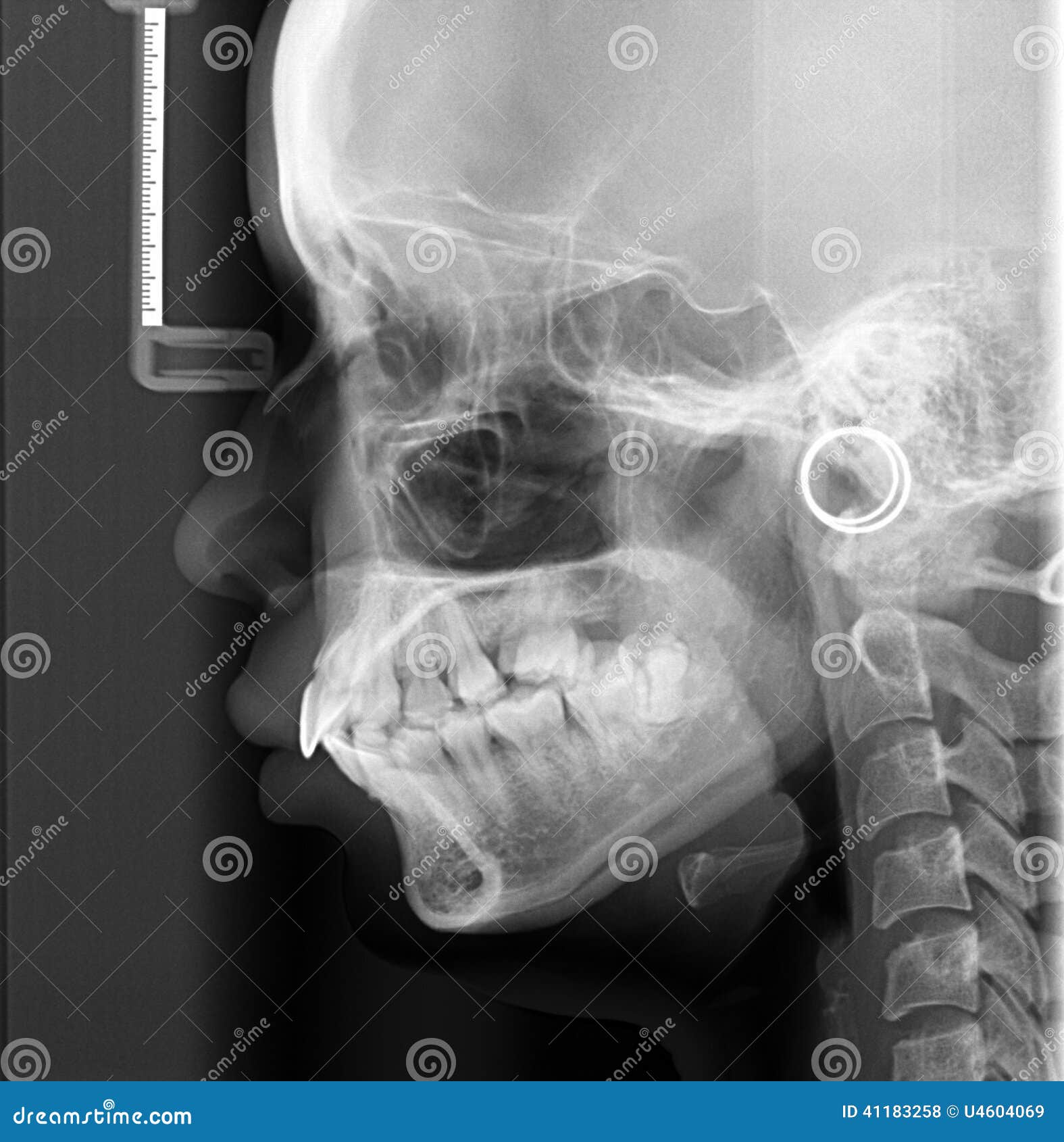 X-ray, Lateral Cephalogram Technique Stock Photo - Image of skeleton ...