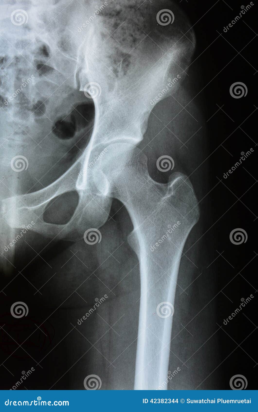 X-ray left hip stock photo. Image of surgery, body, arthritis - 42382344