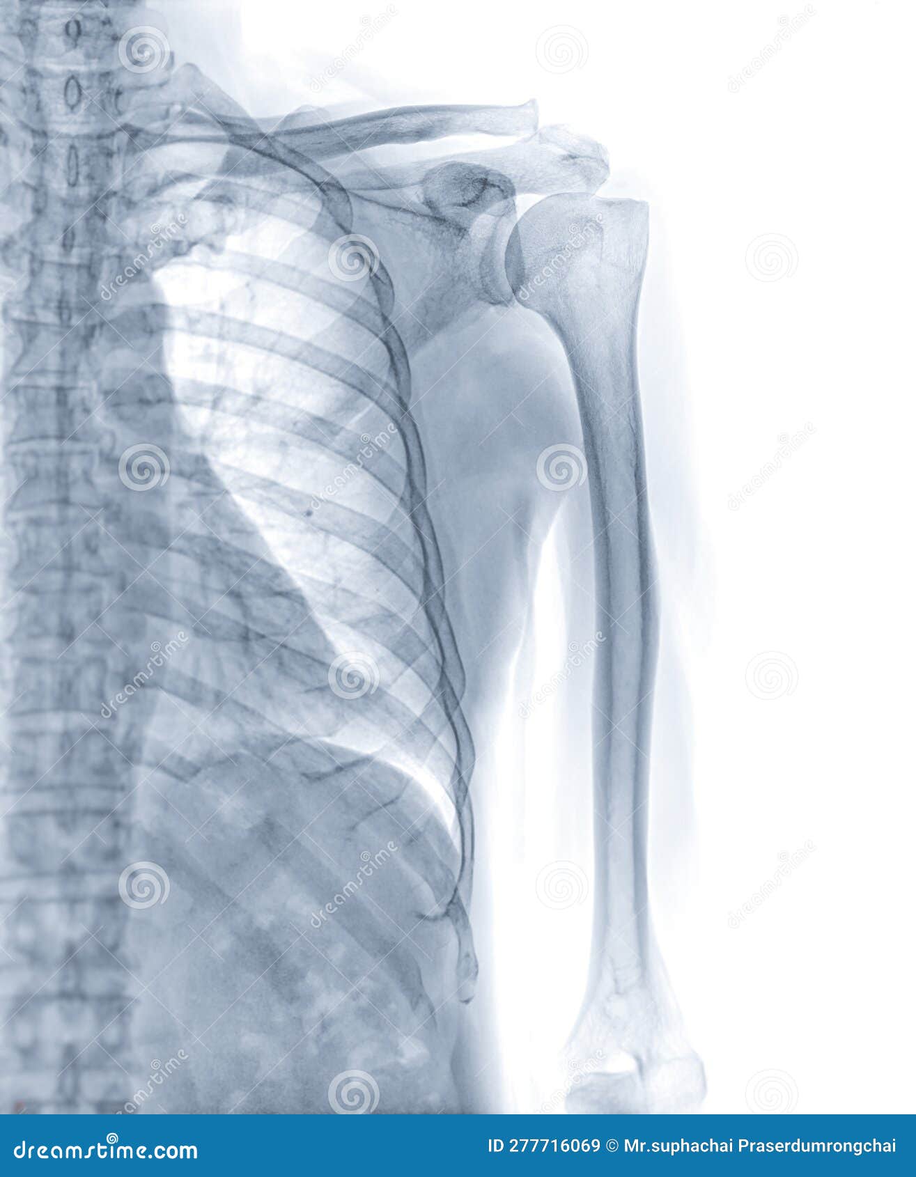 X-ray Image of Humerus Bone. Stock Illustration - Illustration of ...