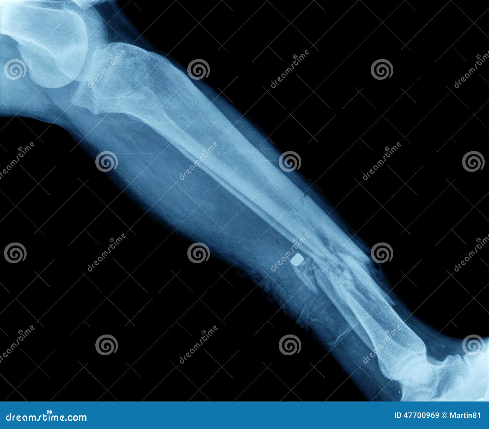 X-ray of leg stock image. Image of health, fibula, equipment - 47700969